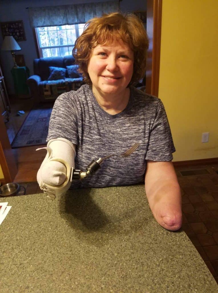 Amputee Life: 5 Things This Quadruple Amputee Does Differently.