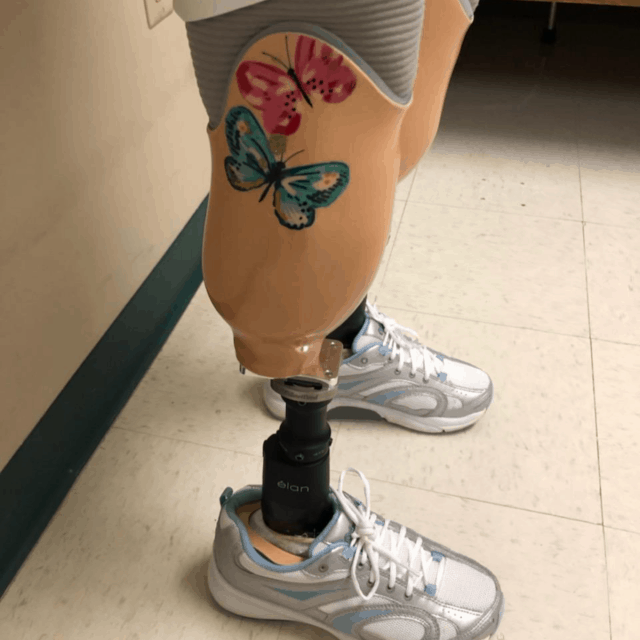 Life After Leg Amputation: 5 Things To Know About Prosthetic Legs